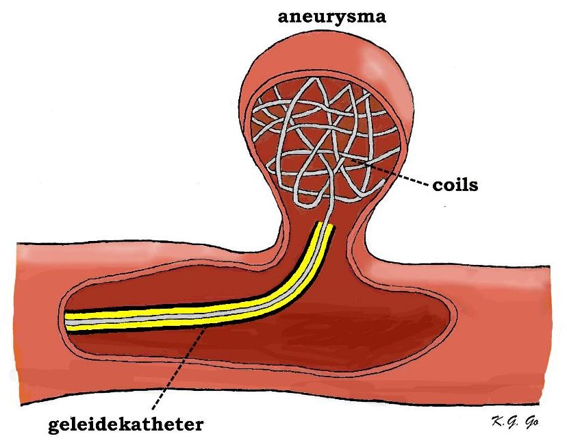 Patiëntenplatform Hersenaneurysma en SAB - Behandelen via coilen