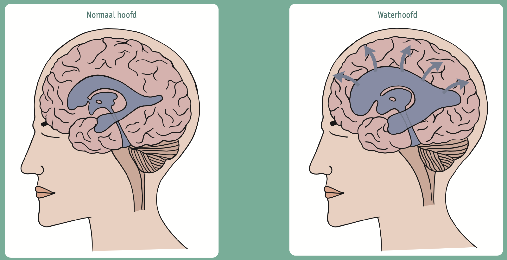 Mogelijke complicaties van de behandelingen – Hersenaneurysma patiënten ...