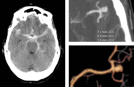 Wat is een SAB? – Hersenaneurysma patiënten platform